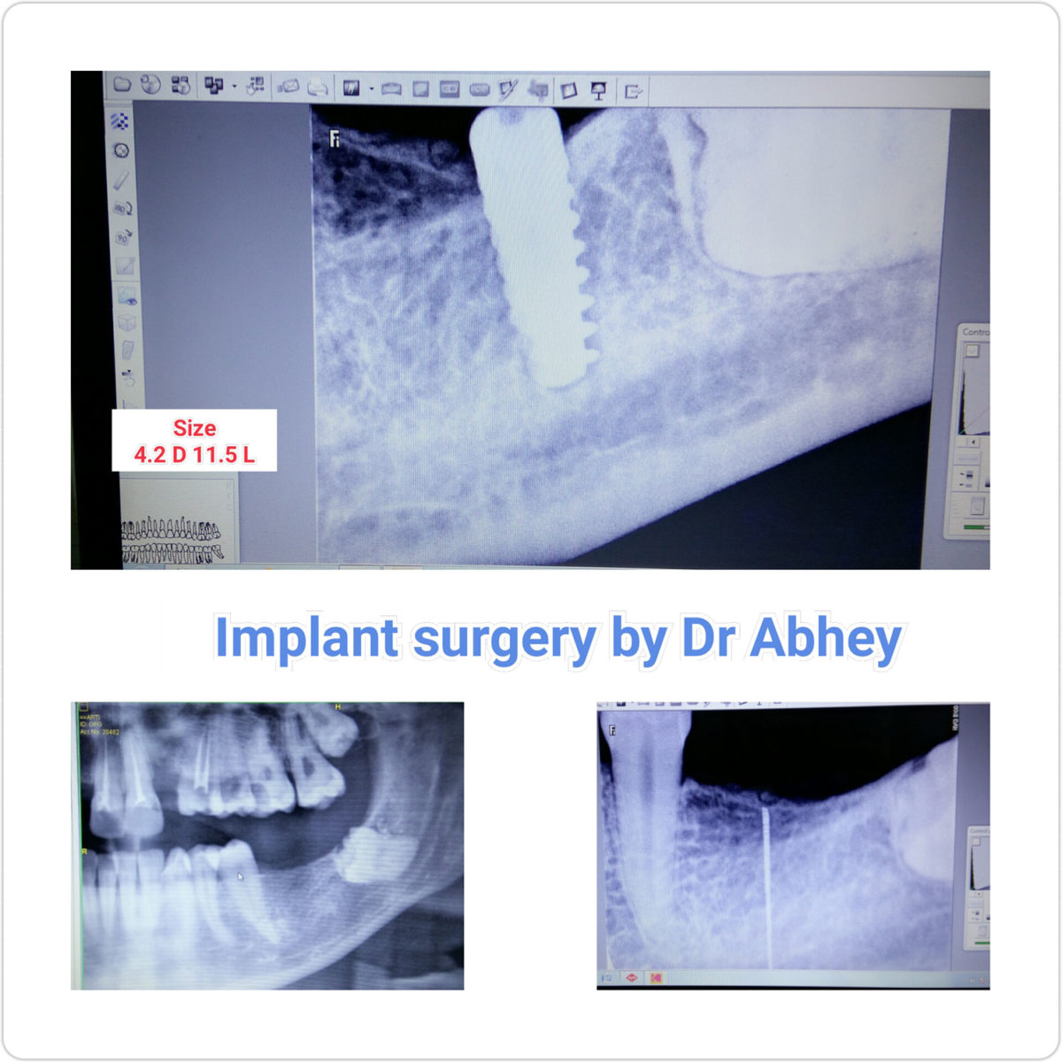 Case Study | ARK Noble Implant Braces Center